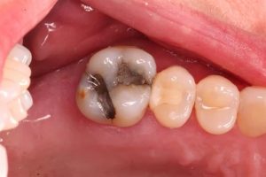 Marginal ridge - Definition of Marginal ridge