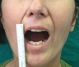 Microstomia - Definition of Microstomia