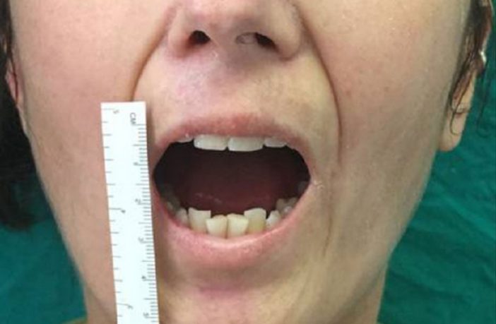 Microstomia - Definition of Microstomia