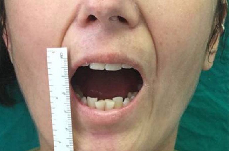 Microstomia - Definition of Microstomia