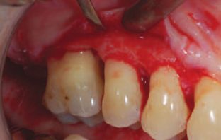 Periodontal suprabony pocket - Definition of Periodontal suprabony pocket
