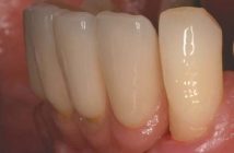 Ridge lap - Definition of Ridge lap