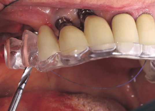 Surgical splint - Definition of Surgical splint