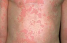 Urticaria - Definition of Urticaria