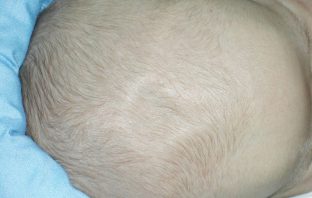 Fomentation - Definition of Fomentation