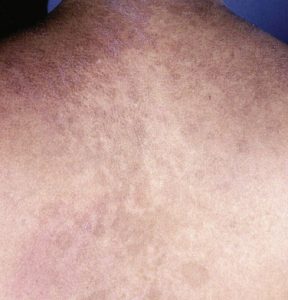 Malassezia - Definition of Malassezia