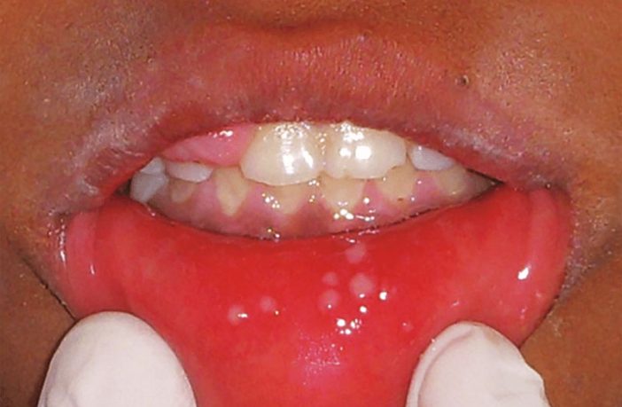 Mucositis - Definition of Mucositis