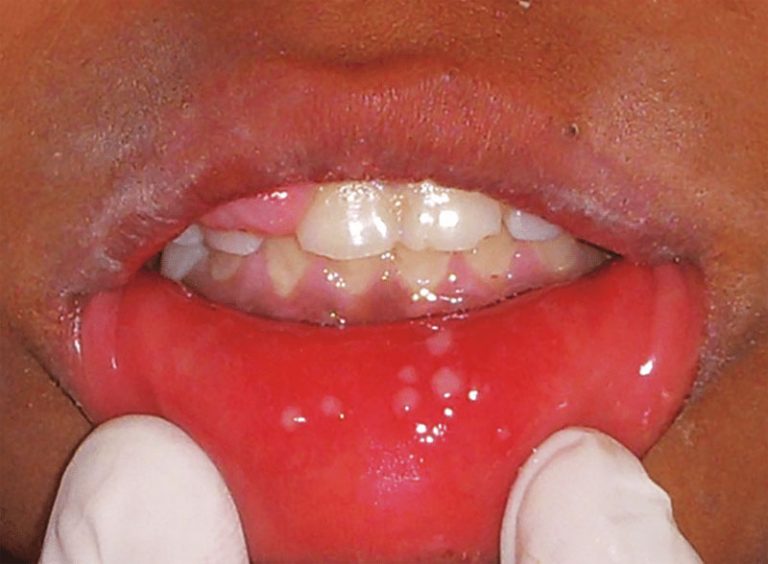 Mucositis - Definition of Mucositis