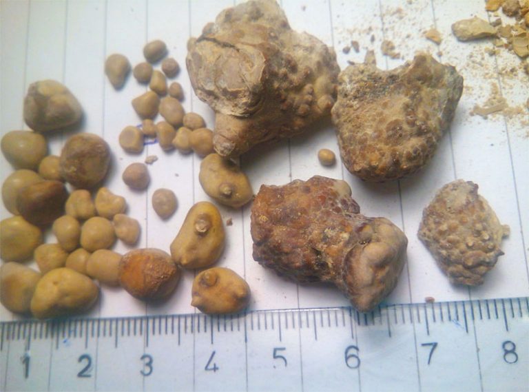 Renal calculi - Definition of Renal calculi