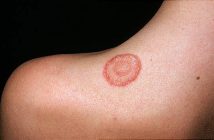 Ringworm - Definition of Ringworm