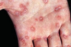 Syphilis - Definition of Syphilis