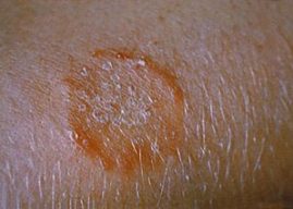 Tinea - Definition of Tinea