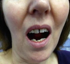 Trismus - Definition of Trismus