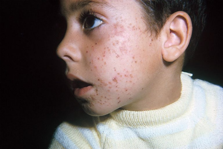 Verruca plana - Definition of Verruca plana