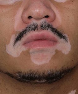 Vitiligo - Definition of Vitiligo
