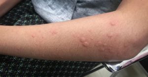 Wheal - Definition of Wheal