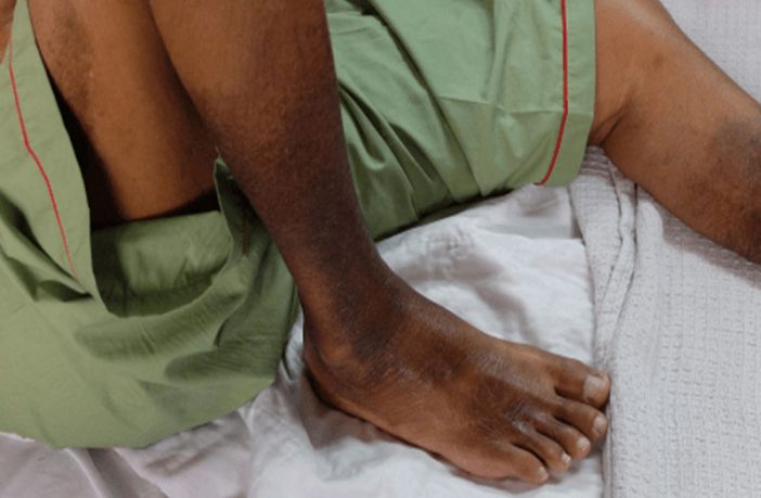 Peripheral artery disease - Definition of Peripheral artery disease