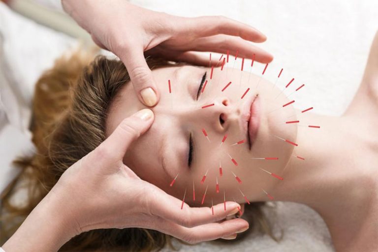 acupuncture-definition-of-acupuncture