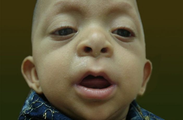 Cretinism - Definition of Cretinism