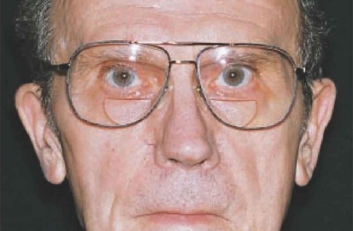 Hypomimia - Definition of Hypomimia