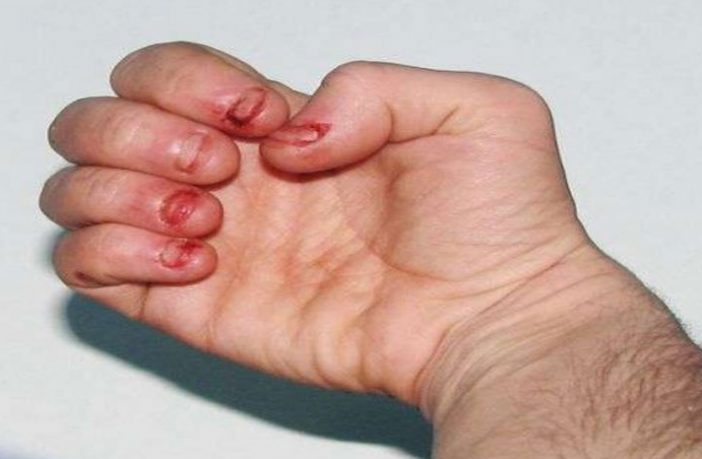 Lesch-nyhan syndrome - Definition of Lesch-nyhan syndrome