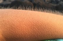 Piloerection - Definition of Piloerection