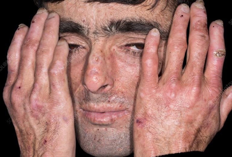 Porphyria - Definition of Porphyria