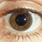 Wilson’s disease - Definition of Wilson’s disease