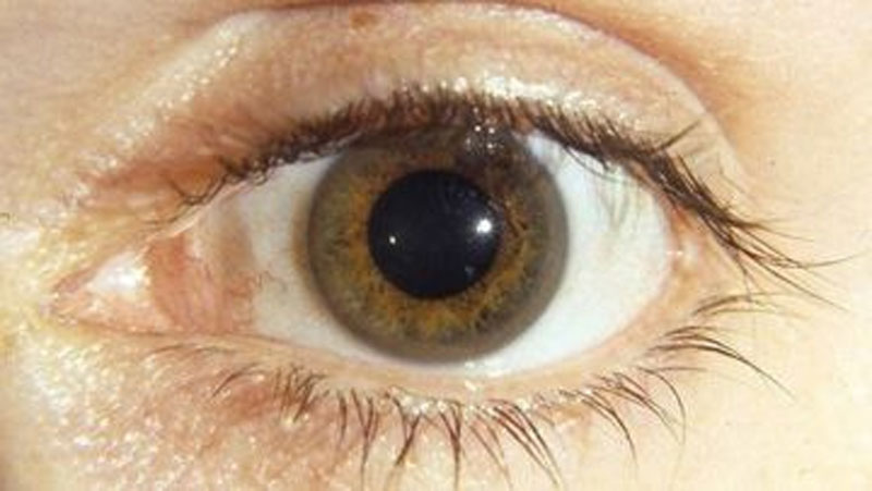 Wilson’s disease - Definition of Wilson’s disease