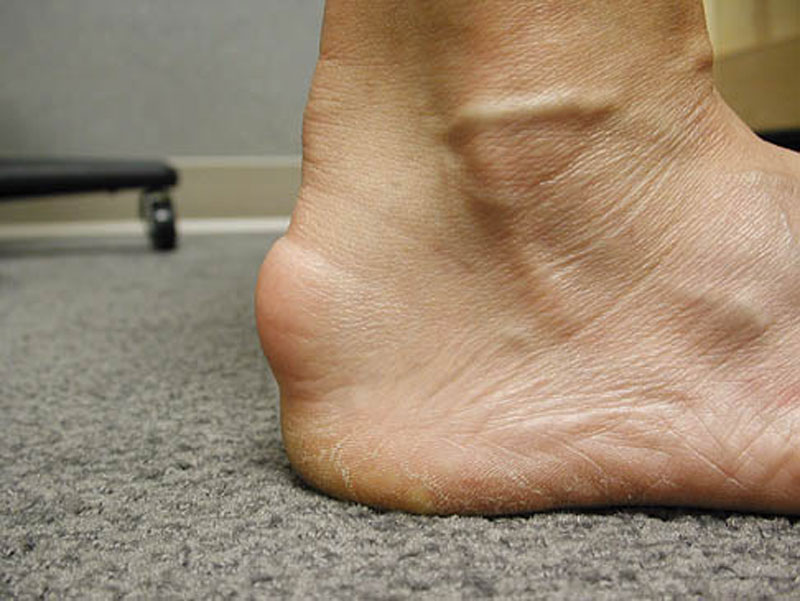 Achilles Tendonitis Definition Of Achilles Tendonitis
