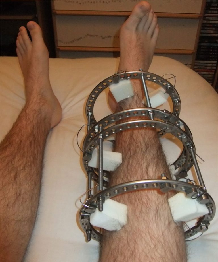 Fixator - Definition of Fixator