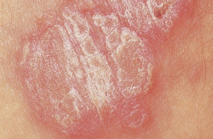 Psoriasis vulgaris - Definition of Psoriasis vulgaris