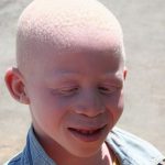 Albinism - Definition of Albinism