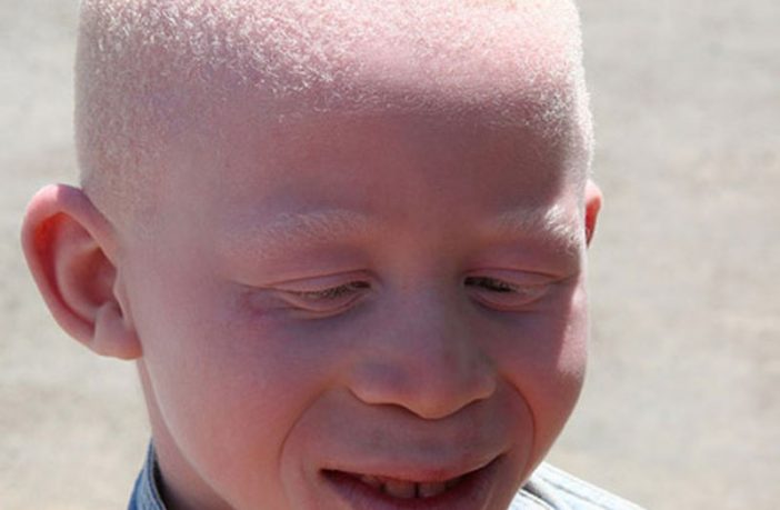 Albinism - Definition of Albinism