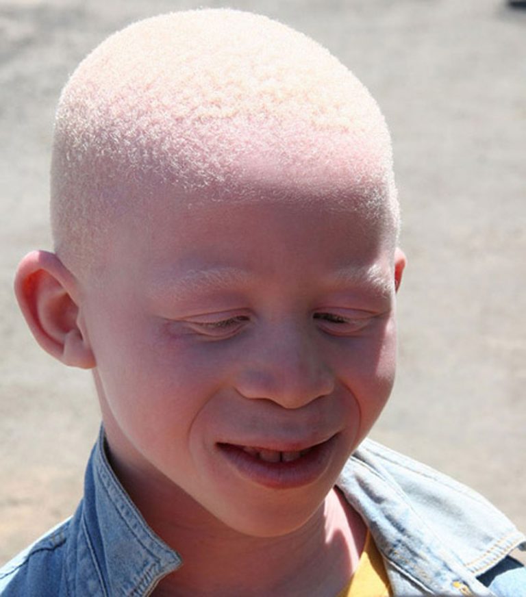 Albinism - Definition of Albinism
