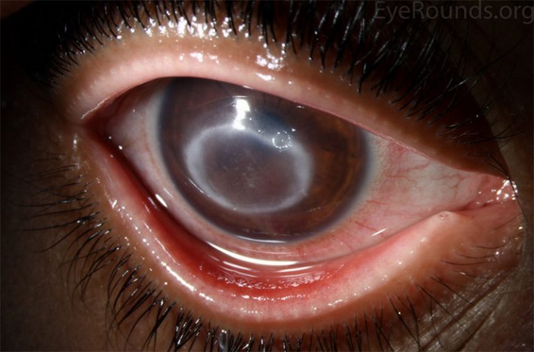Acanthamoeba keratitis - Definition of Acanthamoeba keratitis