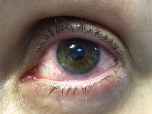 Iritis - Definition of Iritis