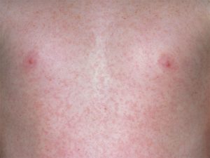 Rubefaction - Definition of Rubefaction