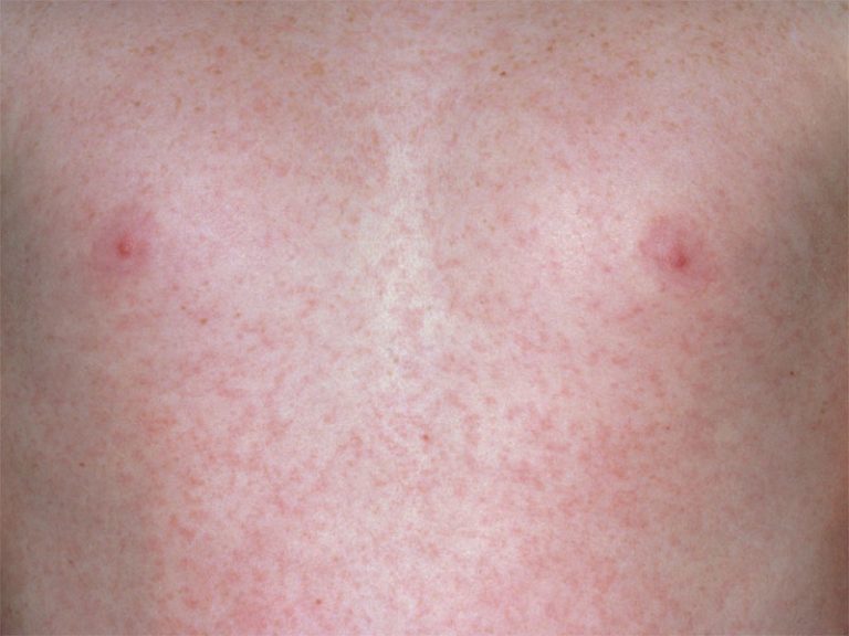 Rubella - Definition of Rubella