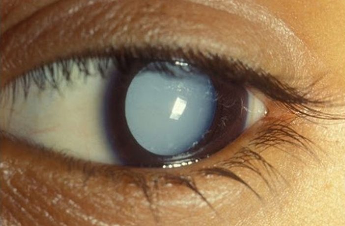 Aphakia - Definition of Aphakia