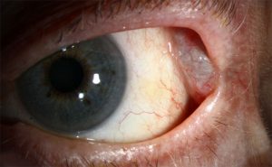 Dacryon - Definition of Dacryon