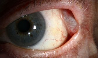 Dacryon - Definition of Dacryon