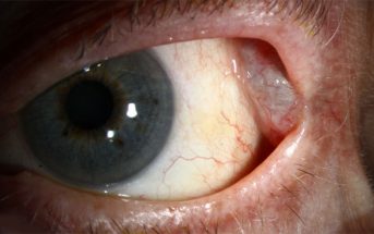 Dacryon - Definition of Dacryon