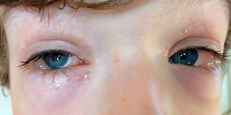 Chemosis - Definition of Chemosis