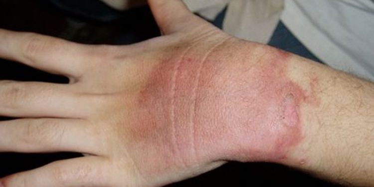 Deep dermal burn - Definition of Deep dermal burn