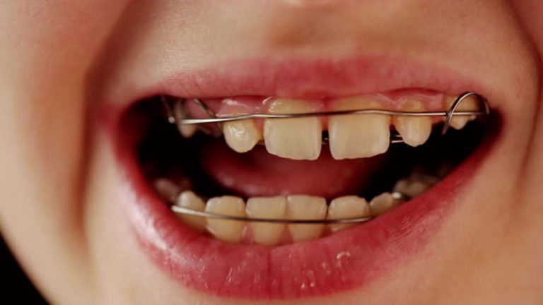 Dental plate - Definition of Dental plate