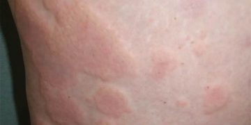 Giant hives - Definition of Giant hives