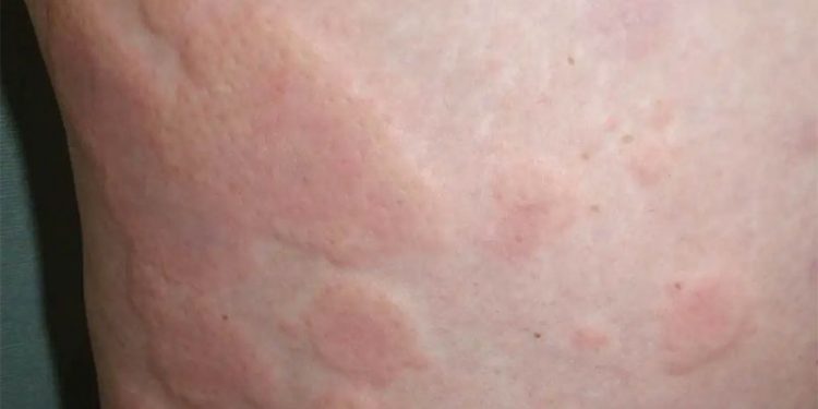 Giant hives - Definition of Giant hives