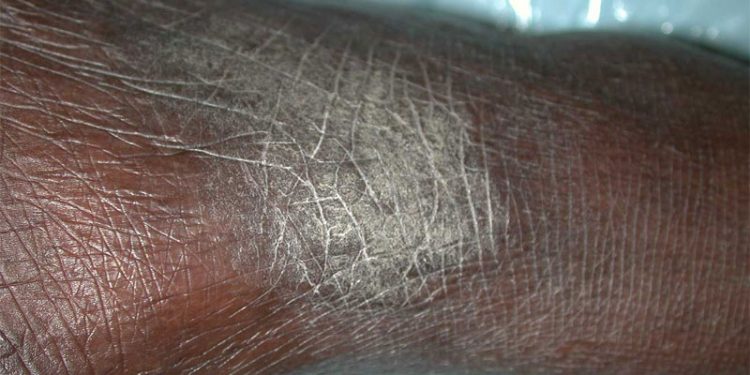 Lichenification - Definition of Lichenification