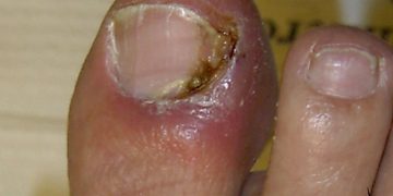 Onychia - Definition of Onychia